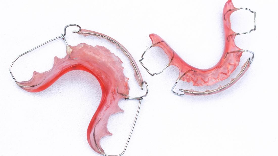 4 Tips for a Clean Retainer | Lucio H. Kim DDS Blog