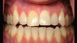 Gum Recession | Dr. Lucio H. Kim | Dentist in Glendale CA